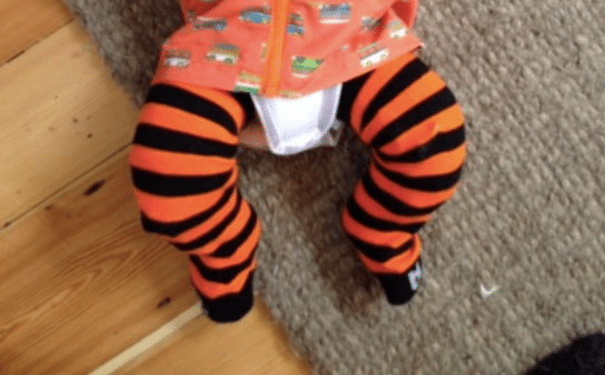 talipes baby legs - Carrying Matters